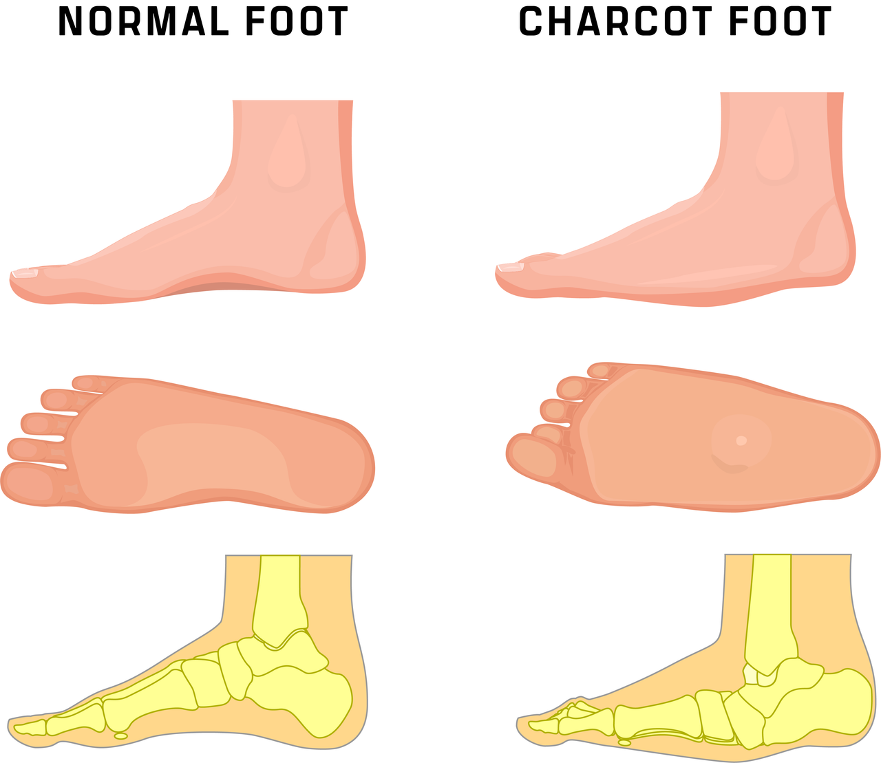 Best Brace for Charcot Neuropathy to Supports Stability & Recovery ...